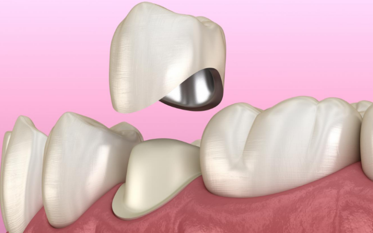 How Does A Dentist Remove A Dental Crown?
